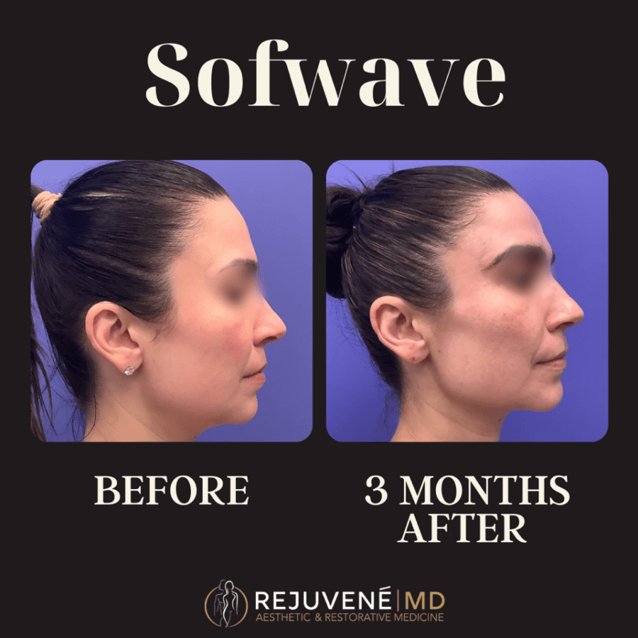 Gallery El Paso TX | Rejuvene MD