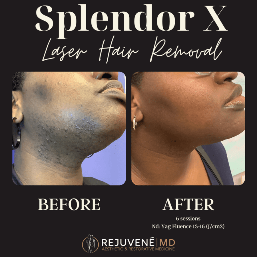 Gallery El Paso TX | Rejuvene MD