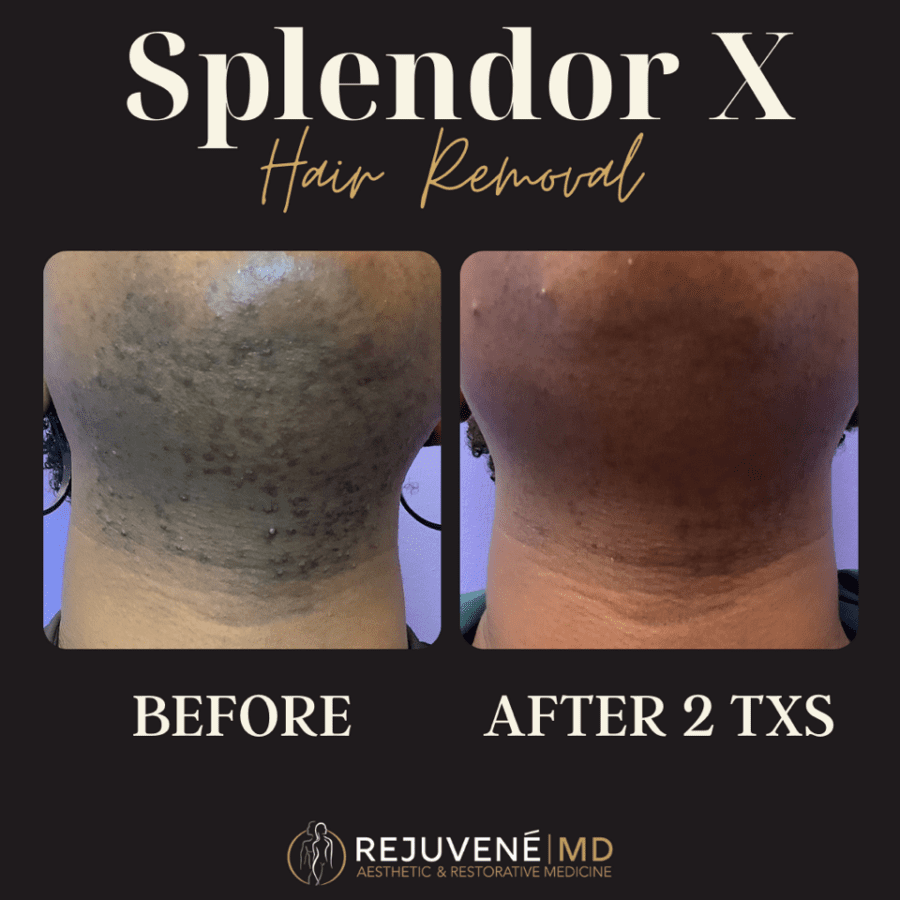 Gallery El Paso TX | Rejuvene MD