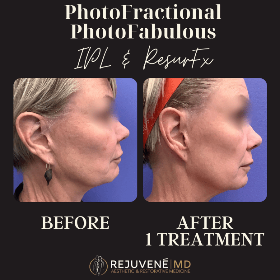 Gallery El Paso TX | Rejuvene MD