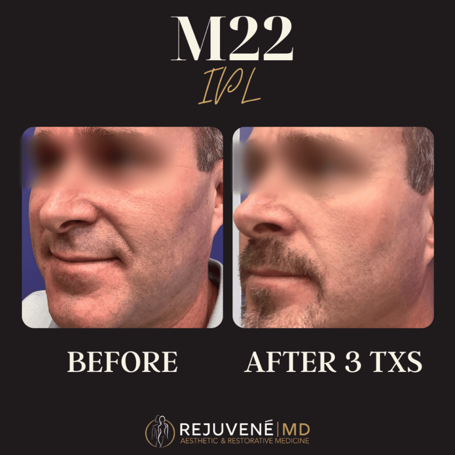 Gallery El Paso TX | Rejuvene MD