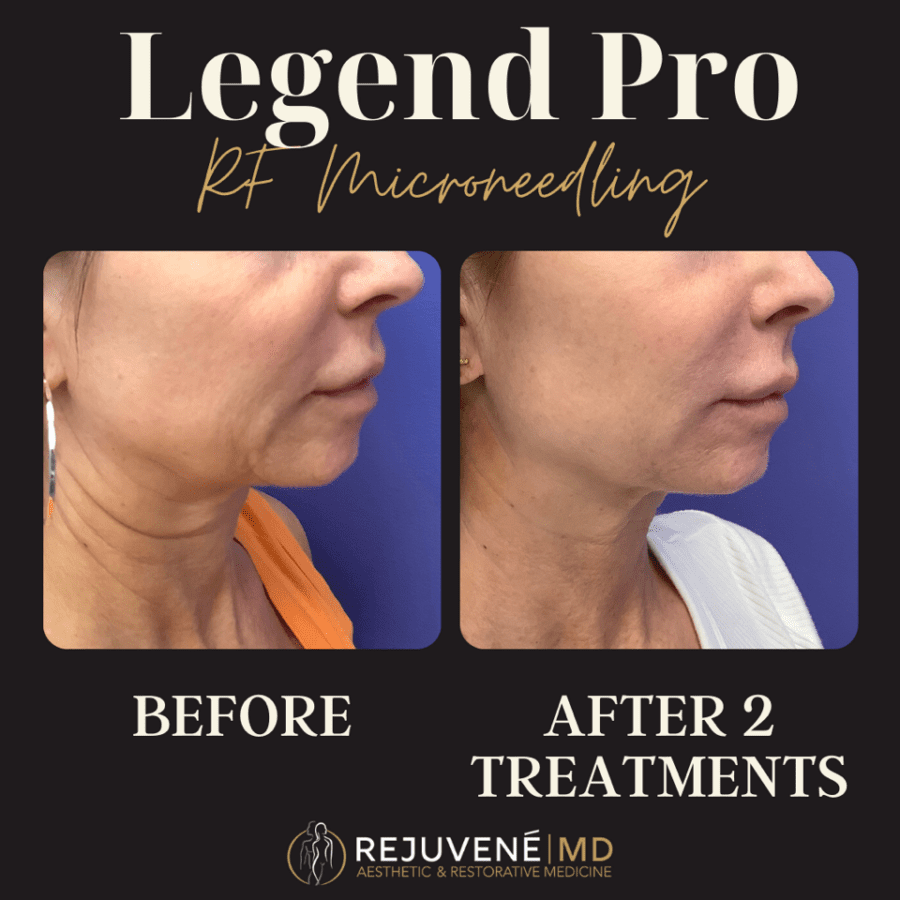 Gallery El Paso TX | Rejuvene MD