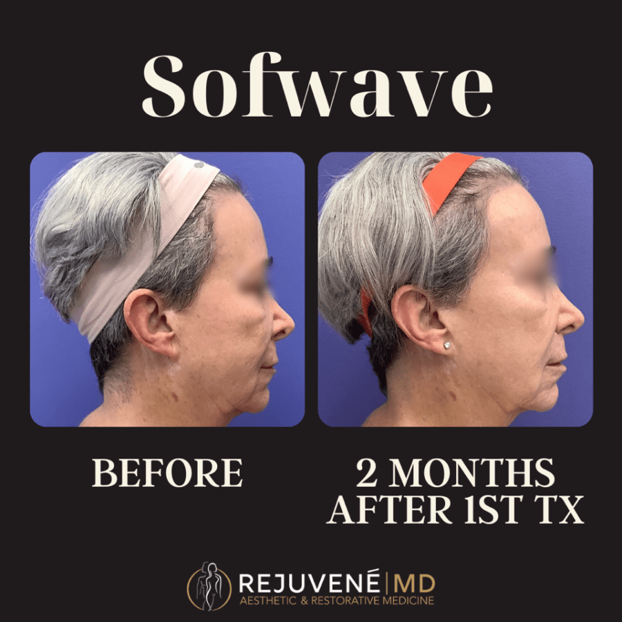 Gallery El Paso TX | Rejuvene MD