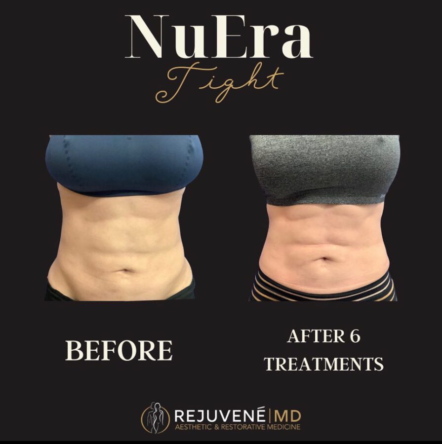 Gallery El Paso TX | Rejuvene MD