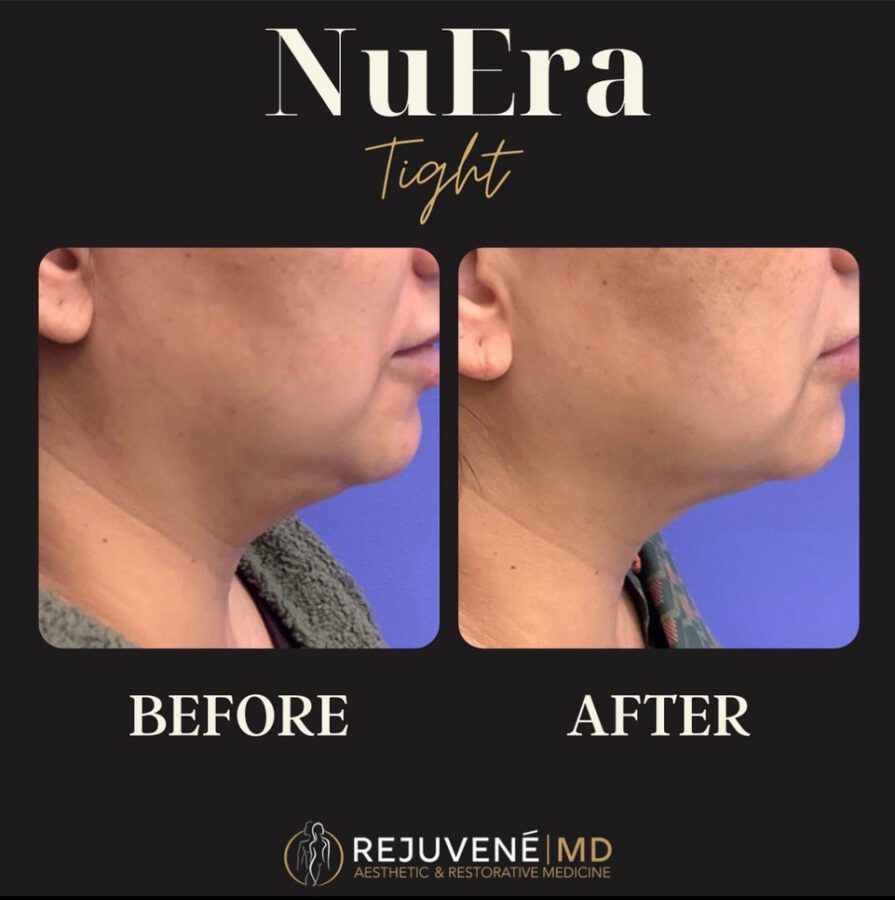 Gallery El Paso TX | Rejuvene MD